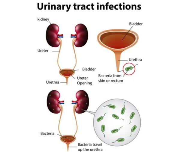 10 Examples of Alpha Blockers For Kidney Stones
